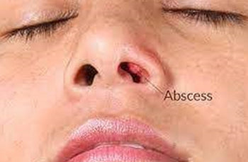 Nasal Vestibulitis: It’s Not a Pimple in Your Nose – Qualicum Beach ...